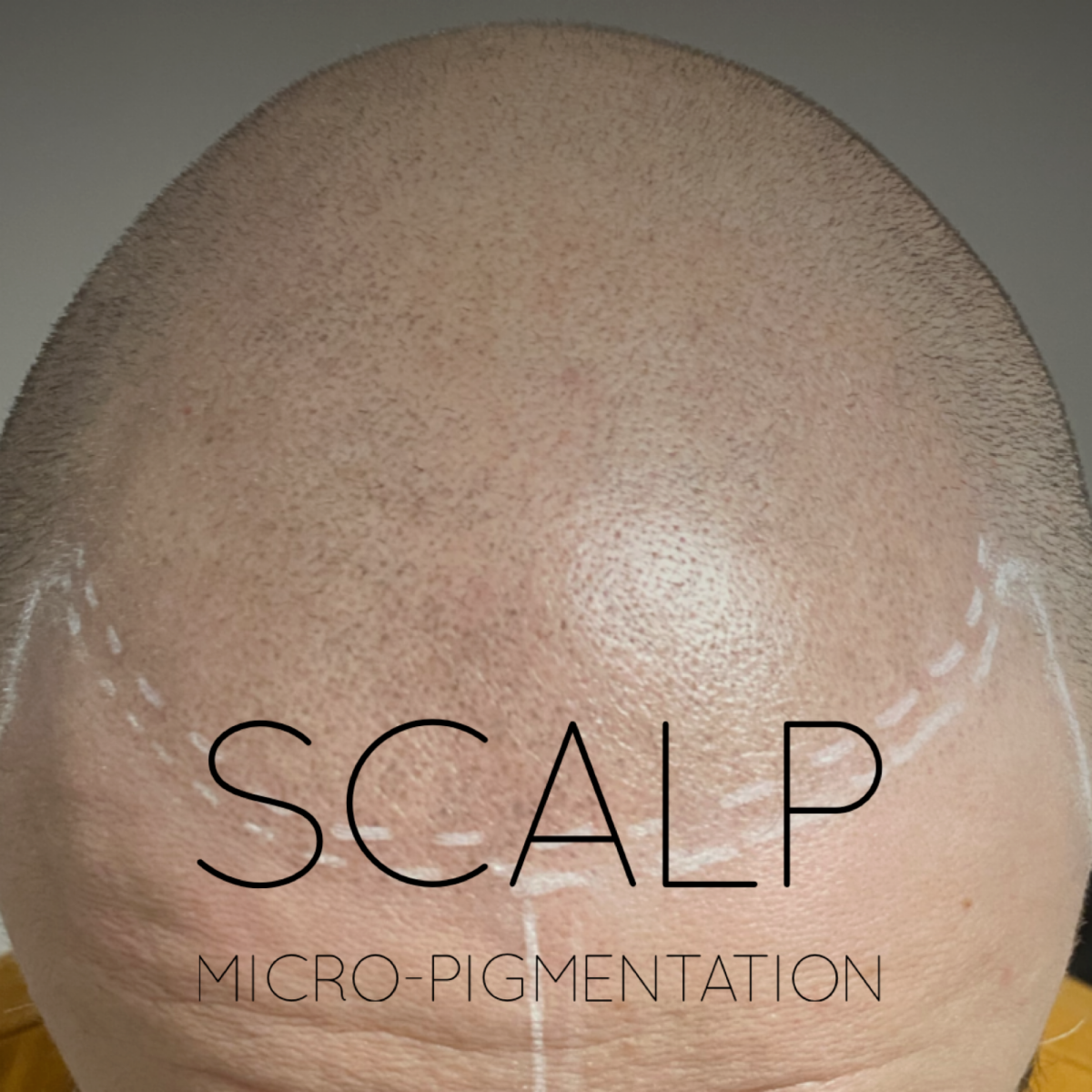 What is scalp micro pigmentation
